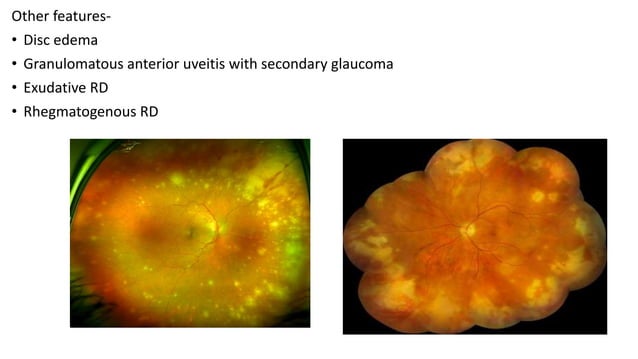 Herpetic viral retinitis | PPTX | Eye and Vision Conditions | Diseases ...