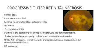 Herpetic viral retinitis | PPTX | Eye and Vision Conditions | Diseases ...