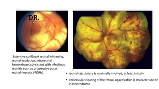 Herpetic viral retinitis | PPTX | Eye and Vision Conditions | Diseases ...
