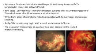 Herpetic viral retinitis | PPTX