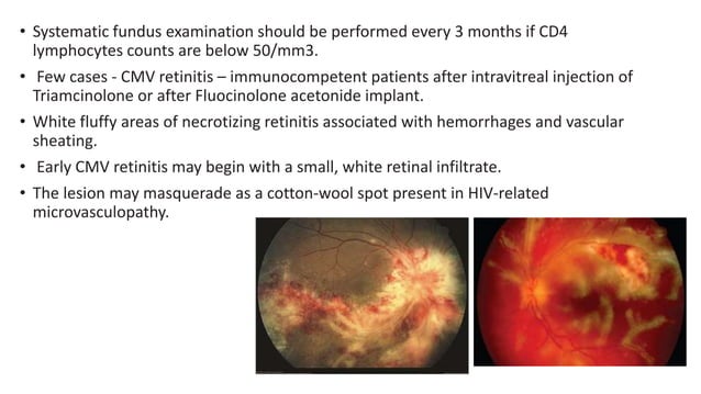 Herpetic viral retinitis | PPTX | Eye and Vision Conditions | Diseases ...