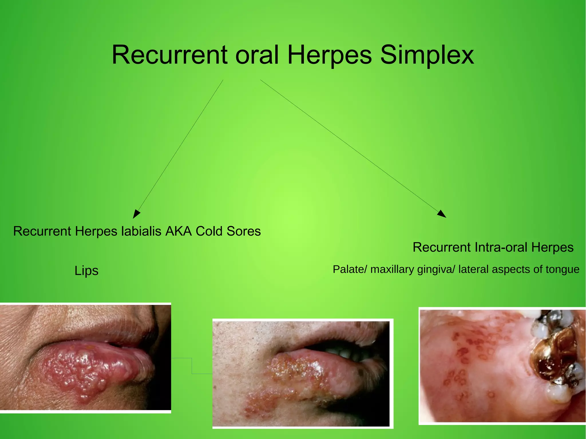 Herpes Simplex RC | ODP | Infectious Diseases | Diseases and Conditions