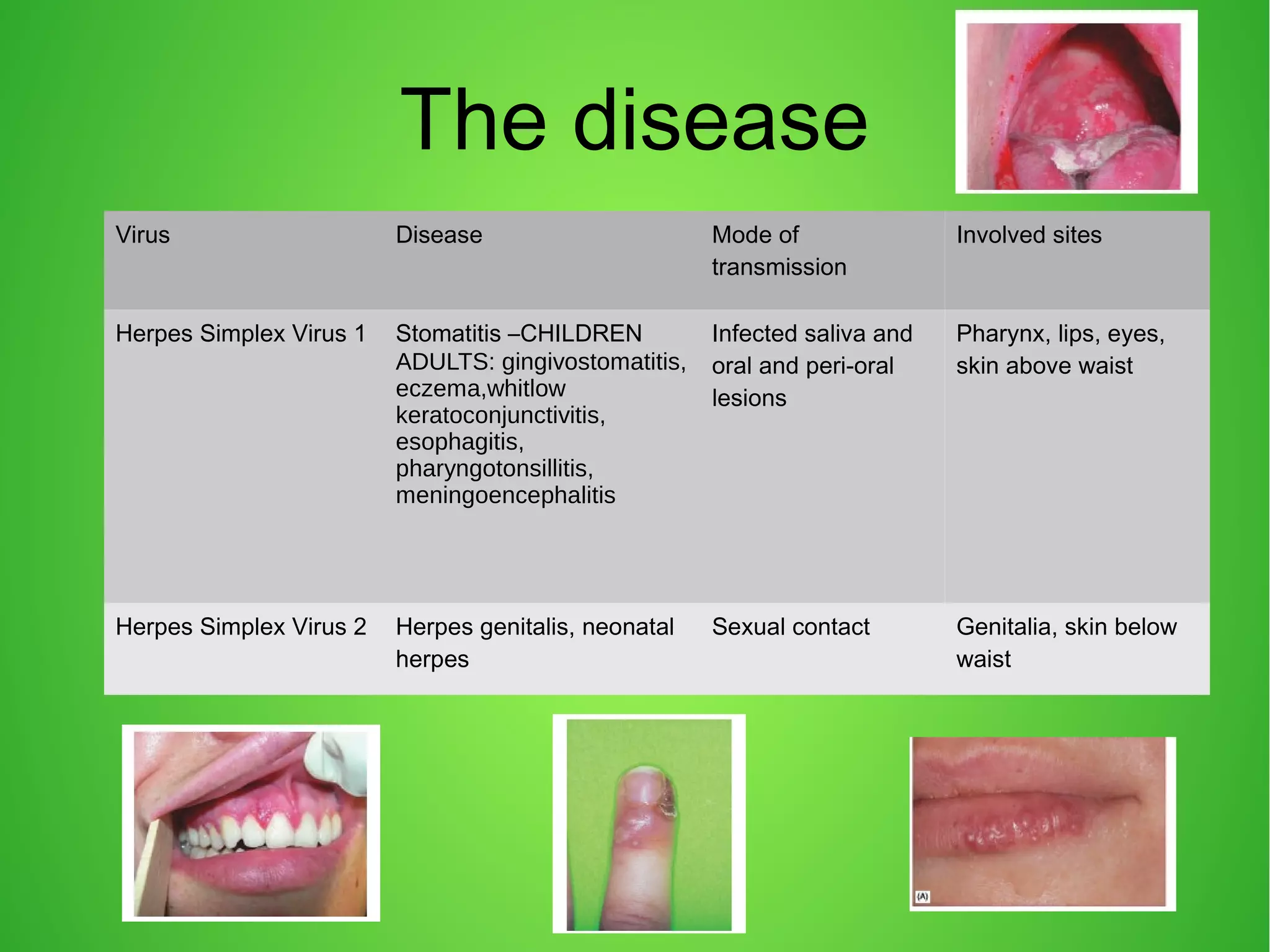 Herpes Simplex RC | ODP