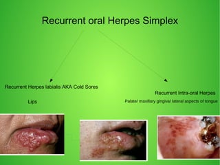 Herpes Simplex RC | ODP