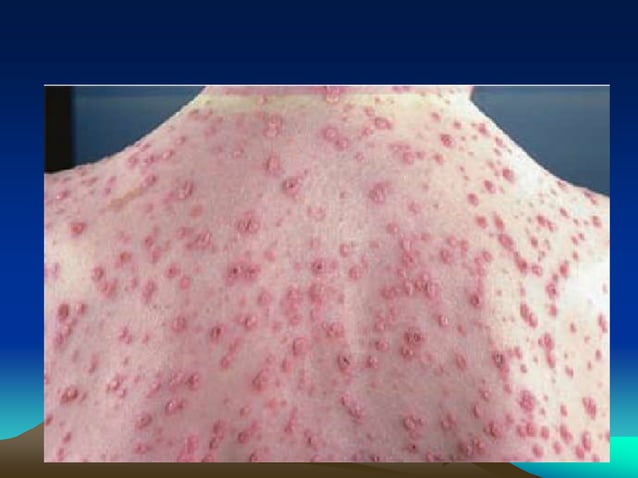 Her simplex Wart Molluscum.ppt | Free Download