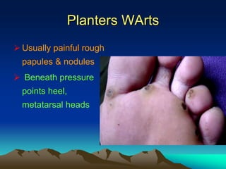 Her simplex Wart Molluscum.ppt