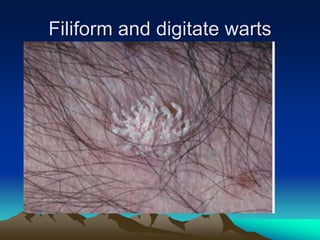 Her simplex Wart Molluscum.ppt