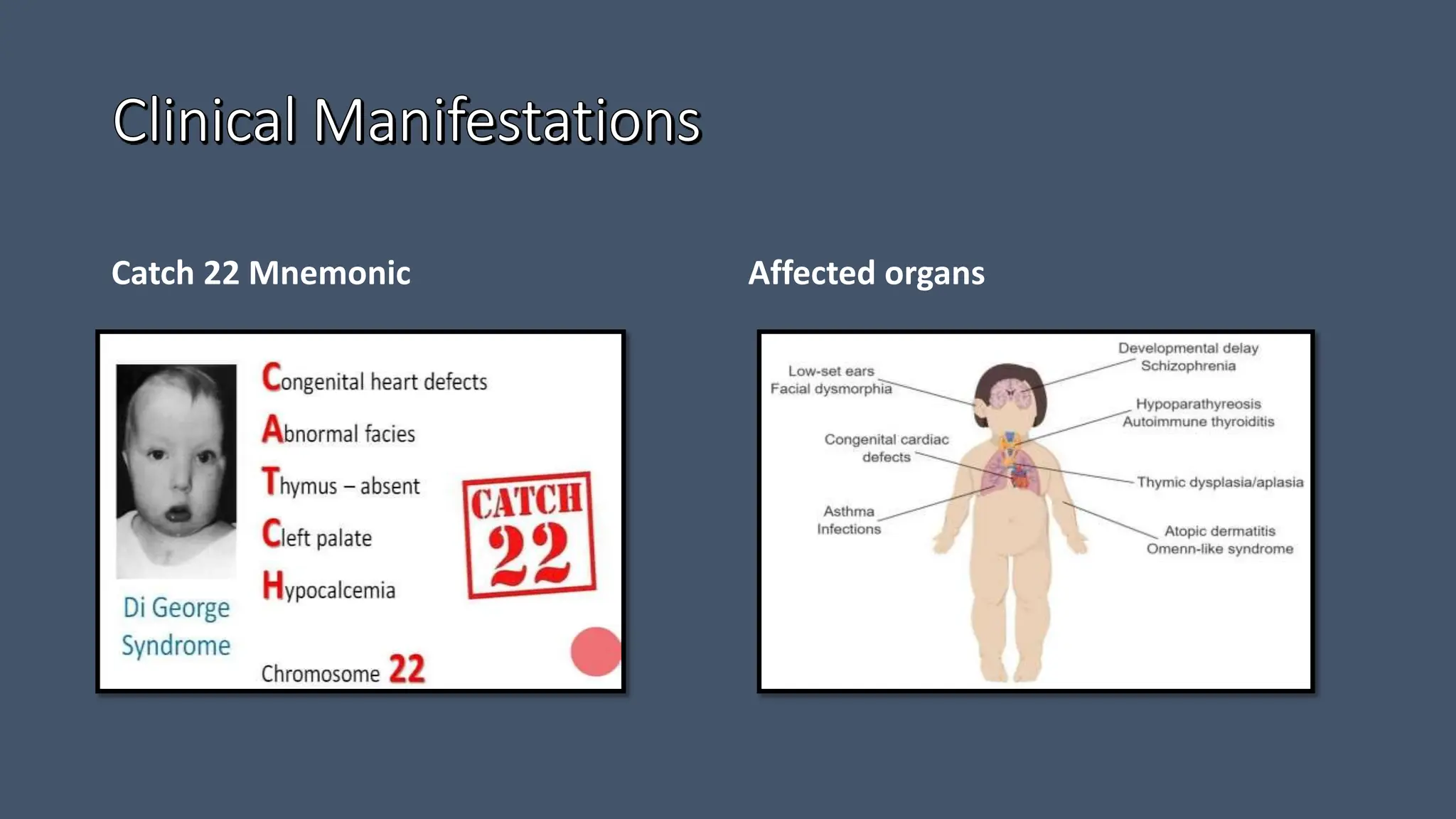 The Di George Syndrome Endocrinology.pptx | Thyroid Disorders ...