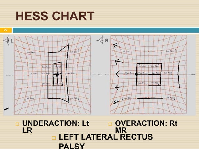 Hess chart | PPTX | Eye and Vision Conditions | Diseases and Conditions