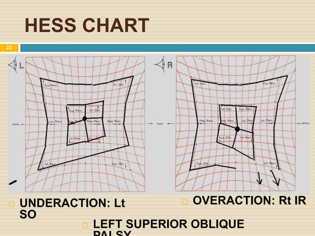 Hess chart | PPTX | Eye and Vision Conditions | Diseases and Conditions