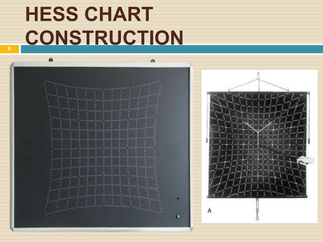 Hess chart | PPTX | Eye and Vision Conditions | Diseases and Conditions