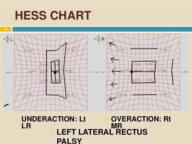 Hess chart