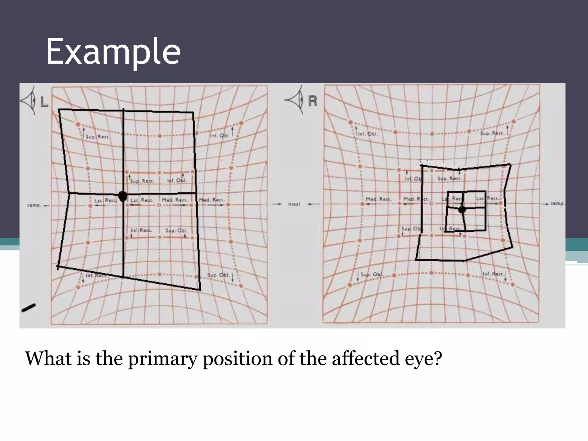 Hess chart and it's Interpretation | PPTX