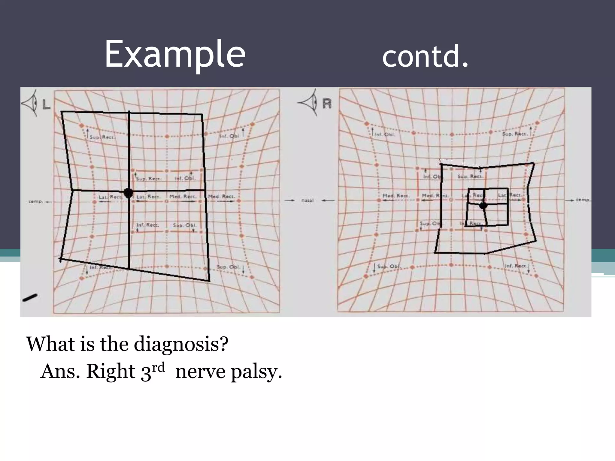 Hess chart and it's Interpretation | PPTX