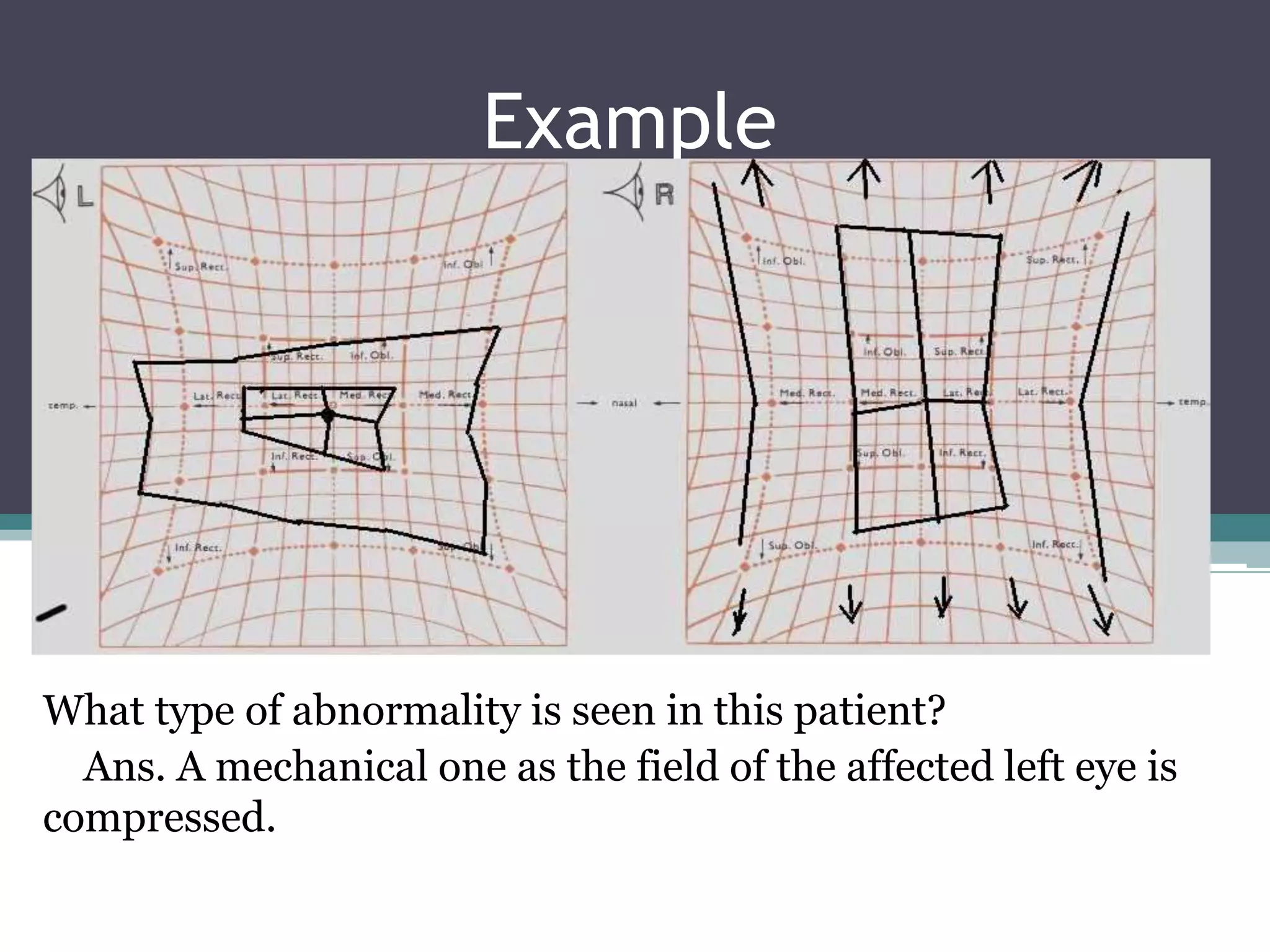 Hess chart and it's Interpretation | PPTX