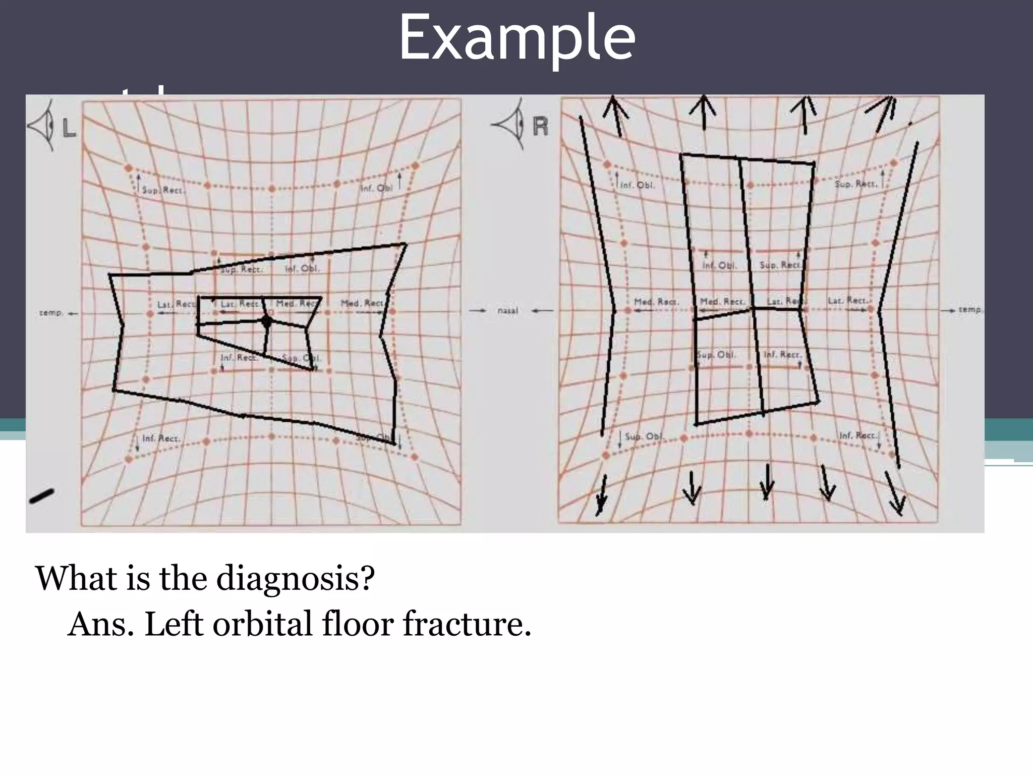 Hess chart and it's Interpretation | PPTX