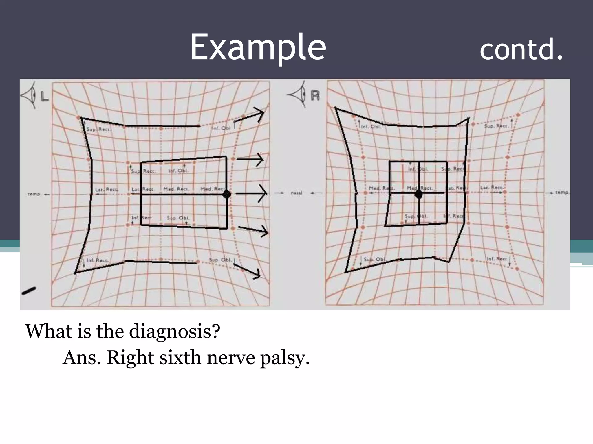 Hess chart and it's Interpretation | PPTX
