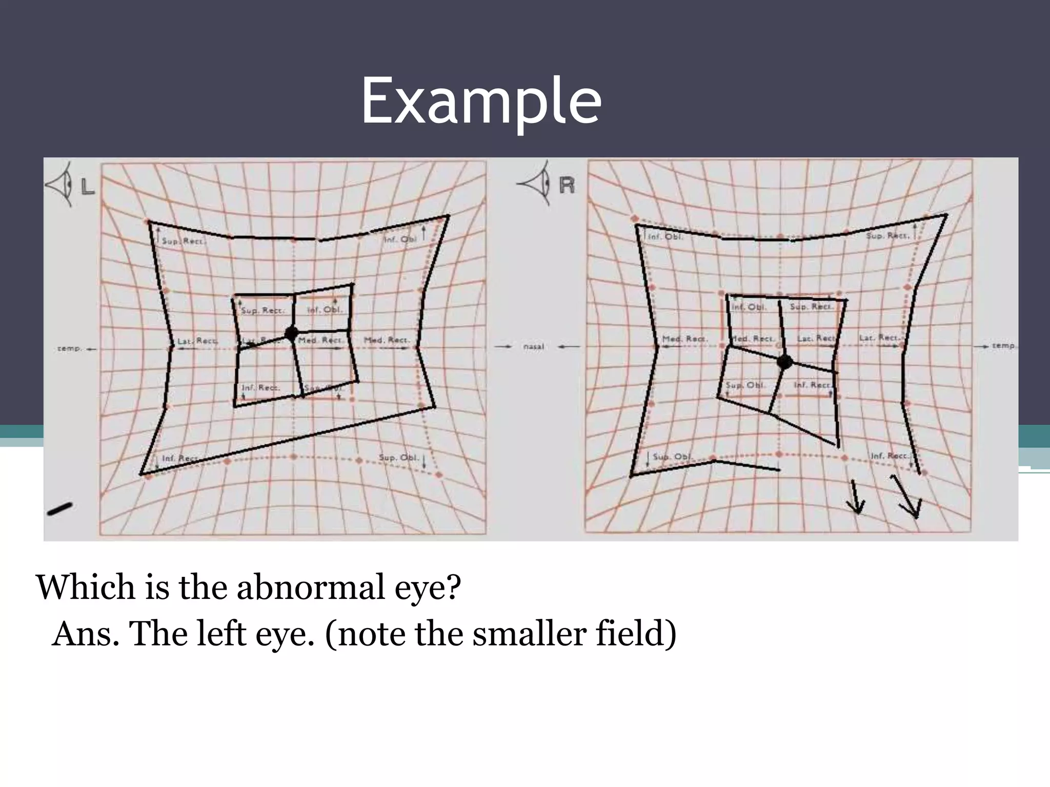 Hess chart and it's Interpretation | PPTX