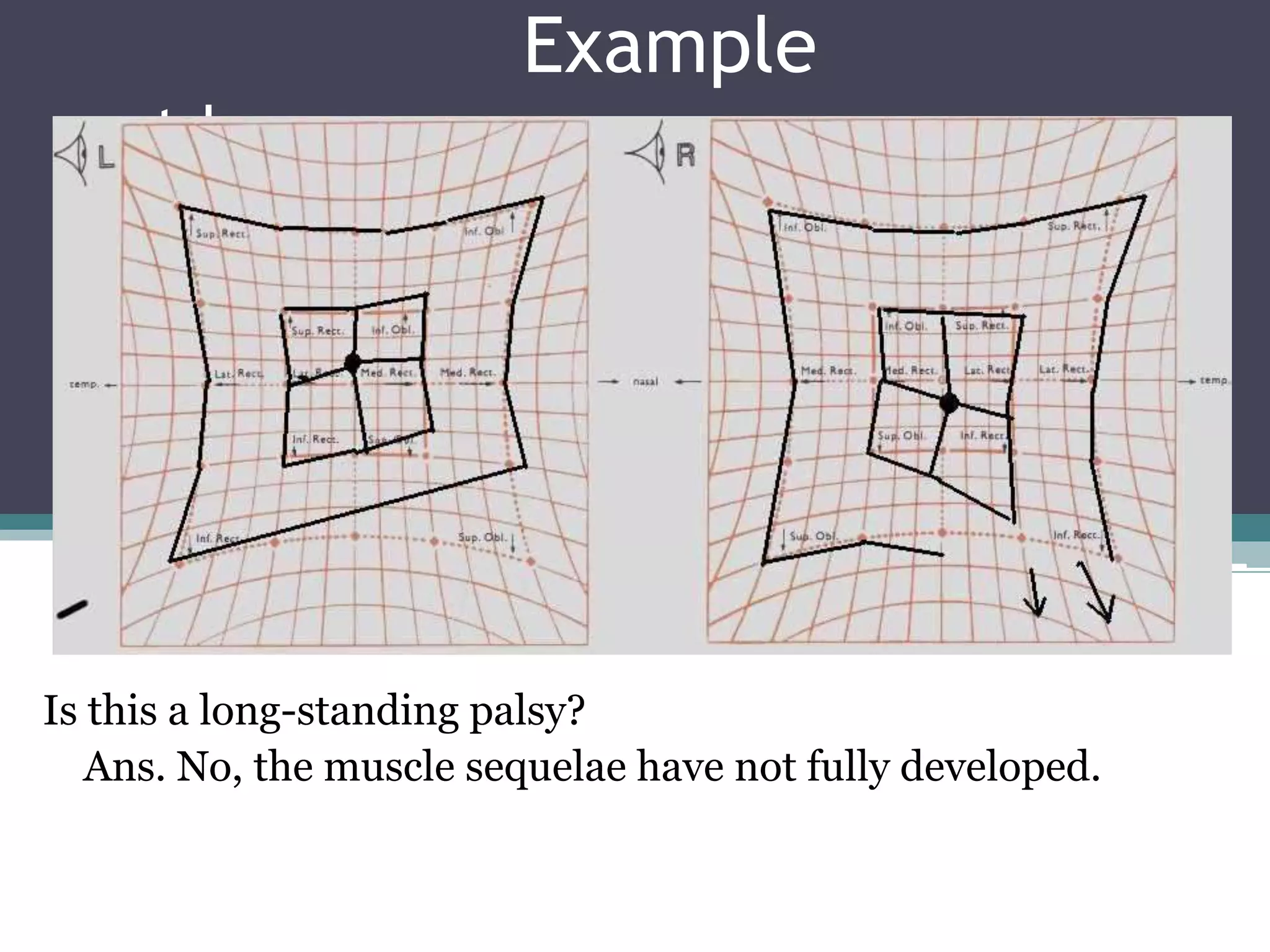 Hess chart and it's Interpretation | PPTX