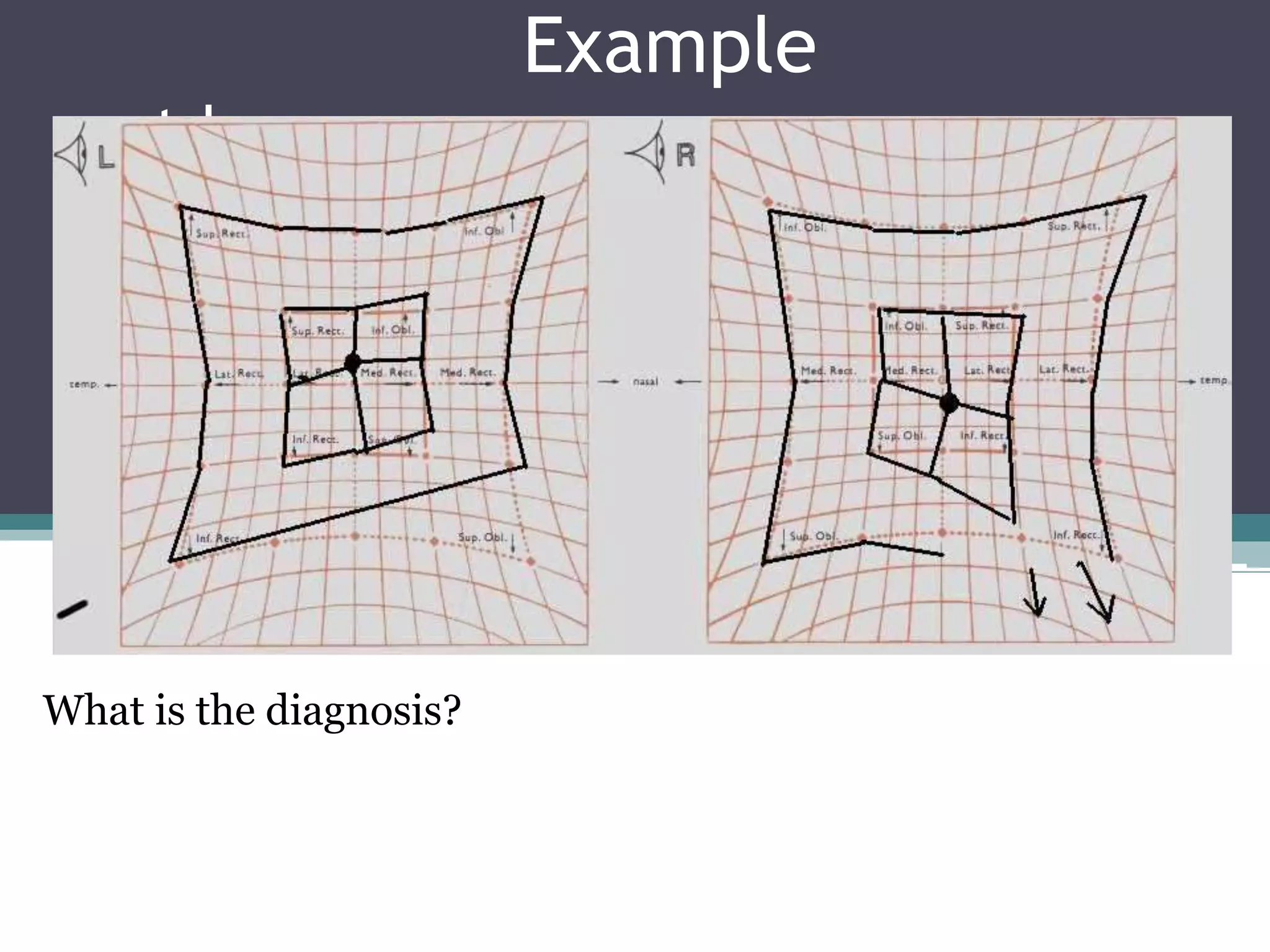 Hess chart and it's Interpretation | PPTX