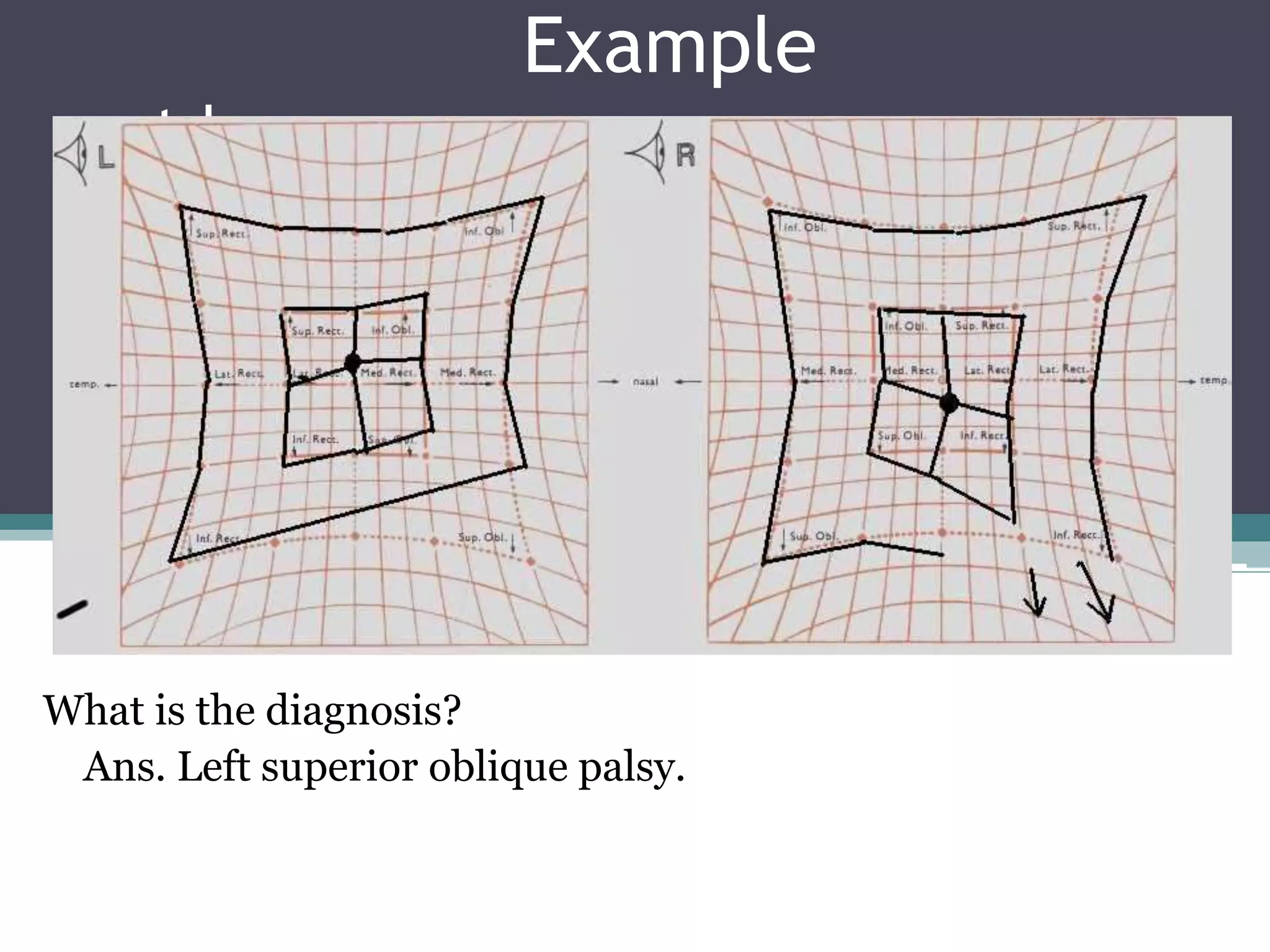 Hess chart and it's Interpretation | PPTX