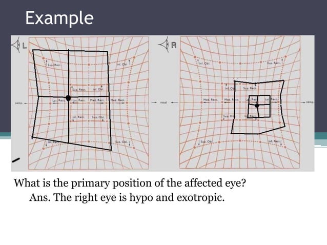 Hess chart and it's Interpretation | PPTX