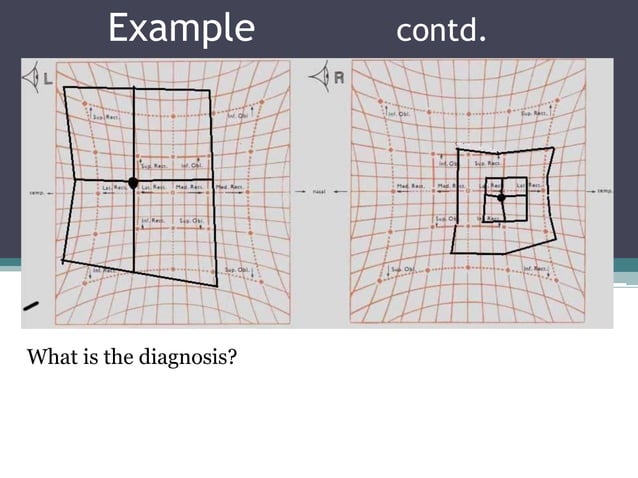 Hess chart and it's Interpretation | PPTX