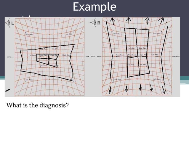 Hess chart and it's Interpretation | PPTX