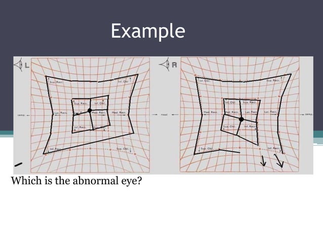 Hess chart and it's Interpretation | PPTX