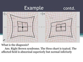 Hess chart and it's Interpretation | PPTX