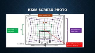 Hess chart, diplopia chart, cover tests | PPTX