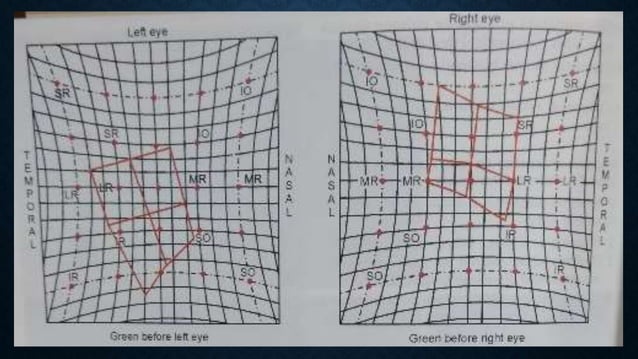 Hess chart, diplopia chart, cover tests | PPTX