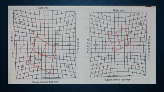Hess chart, diplopia chart, cover tests | PPTX