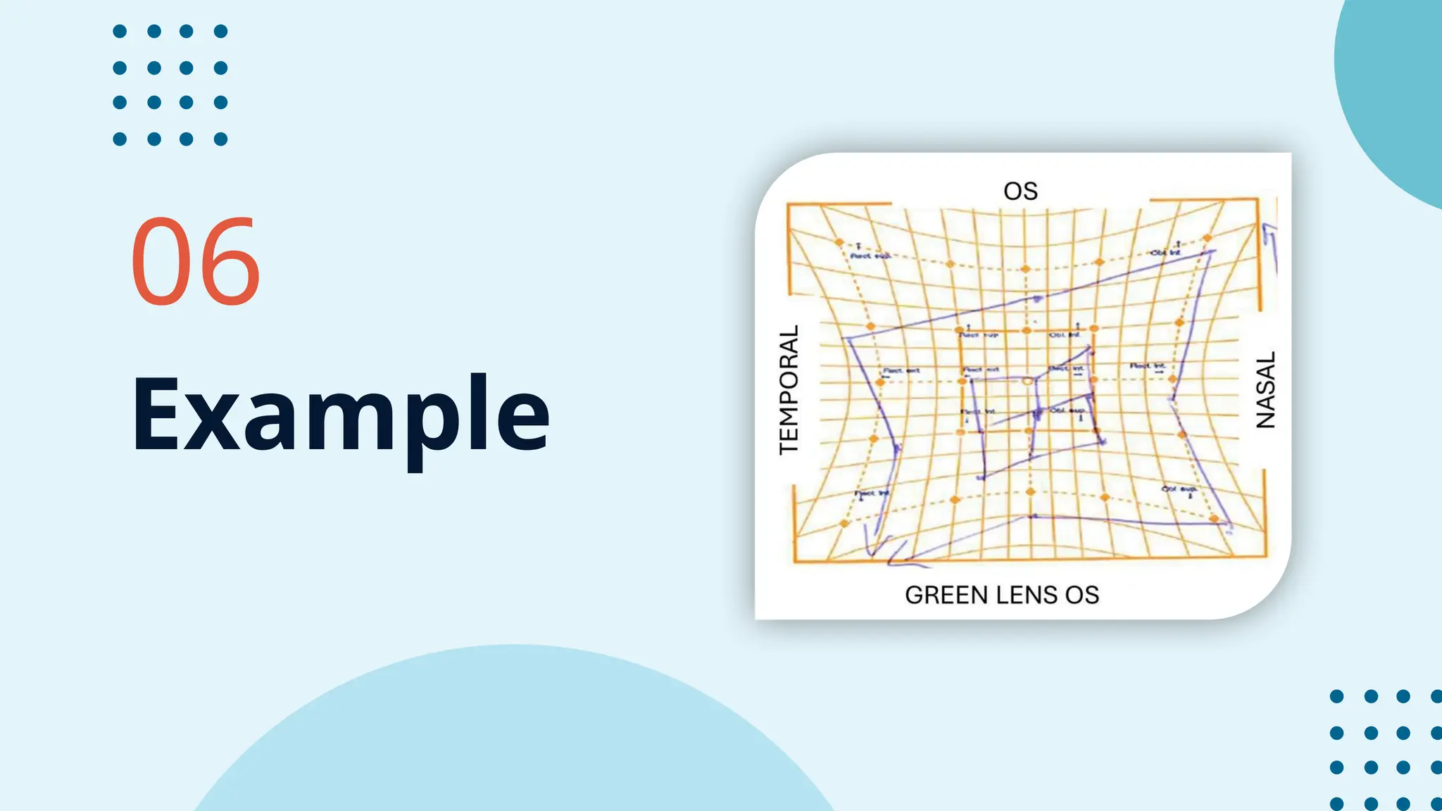 Hess Screen Test Explained: Methodology, Applications & Clinical ...