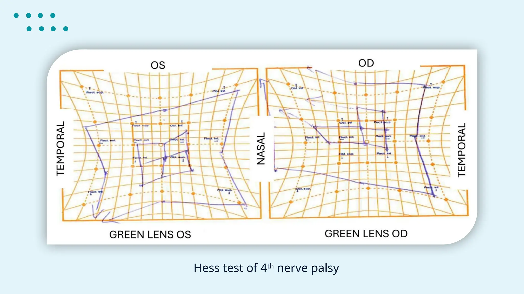 Hess Screen Test Explained: Methodology, Applications & Clinical ...