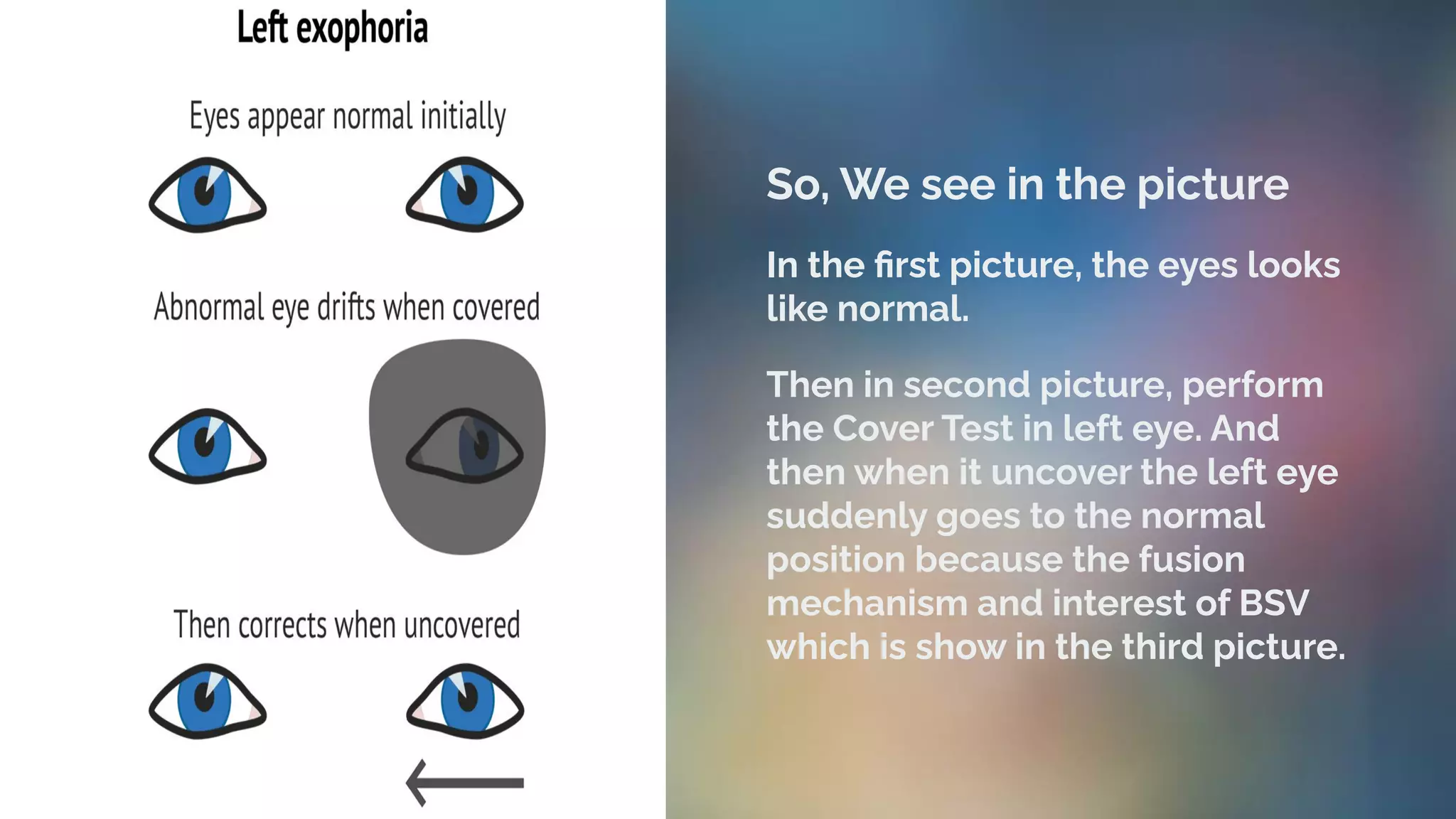 Heterophoria.ppt by Optom. Saharukh Alam | PDF