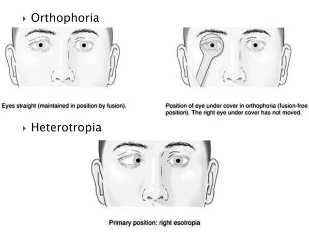 Heterophoria.pptx | Eye and Vision Conditions | Diseases and Conditions
