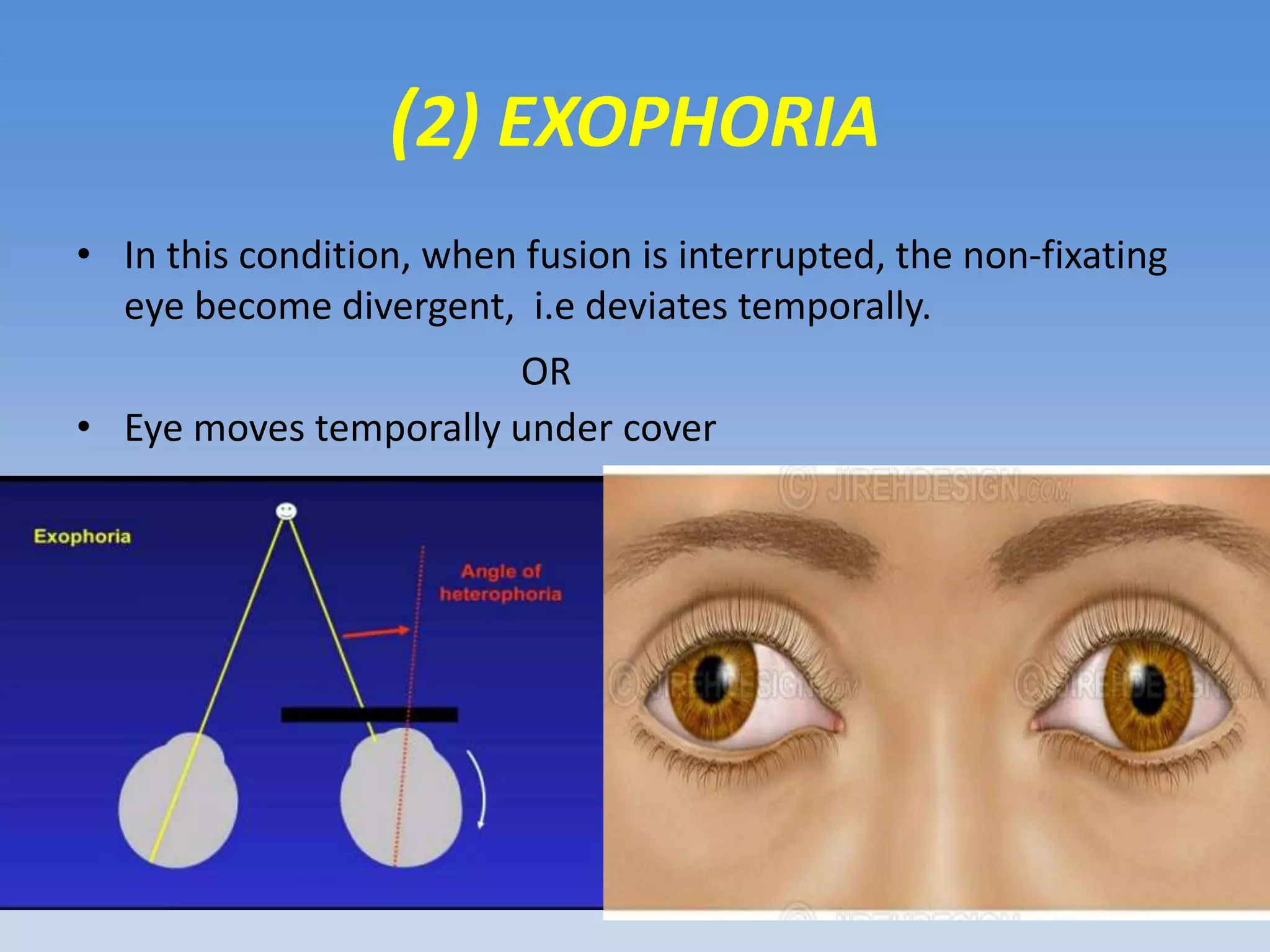 Heterophoria Or Latent Squint | PPTX