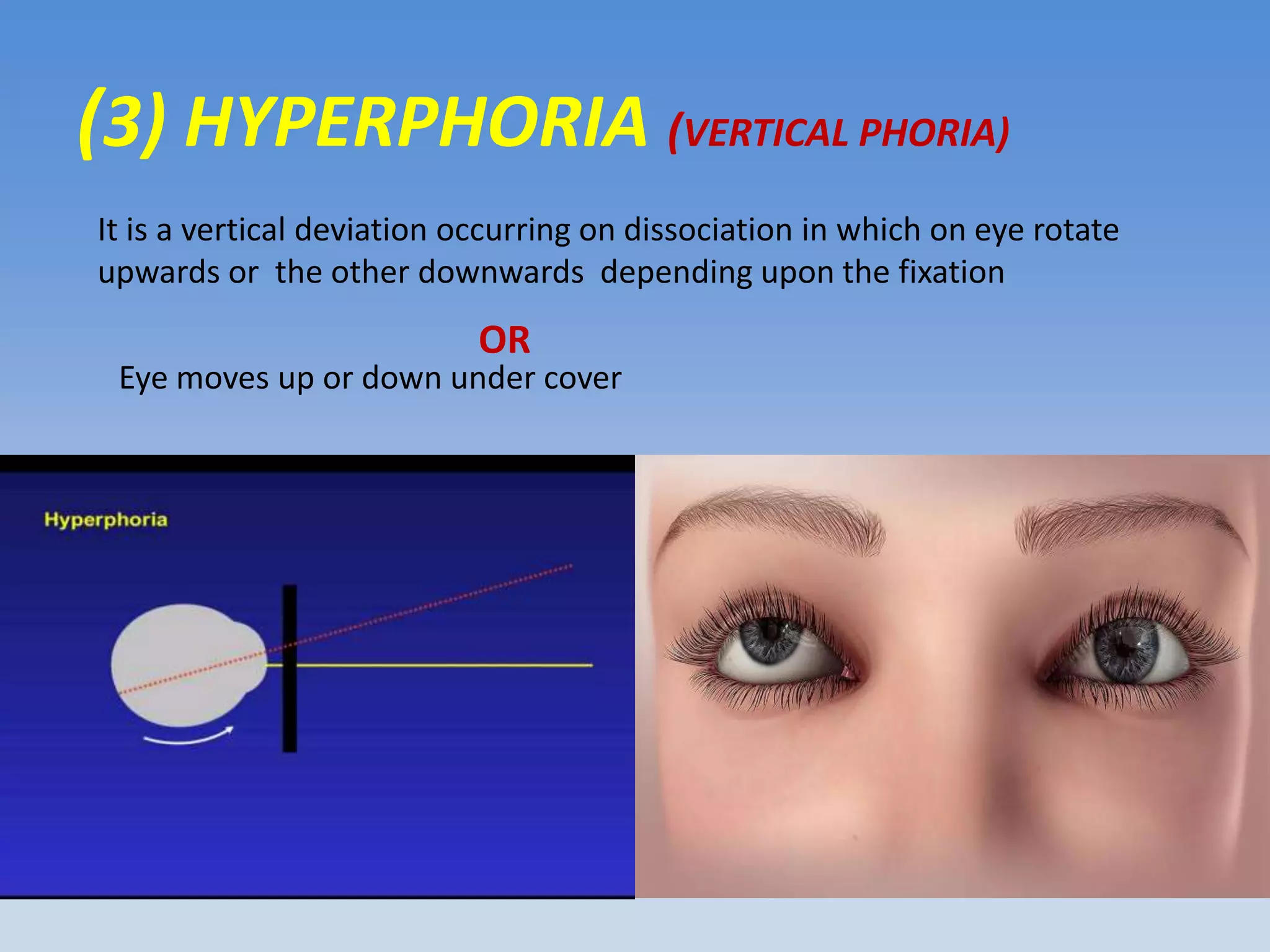 Heterophoria Or Latent Squint | PPTX