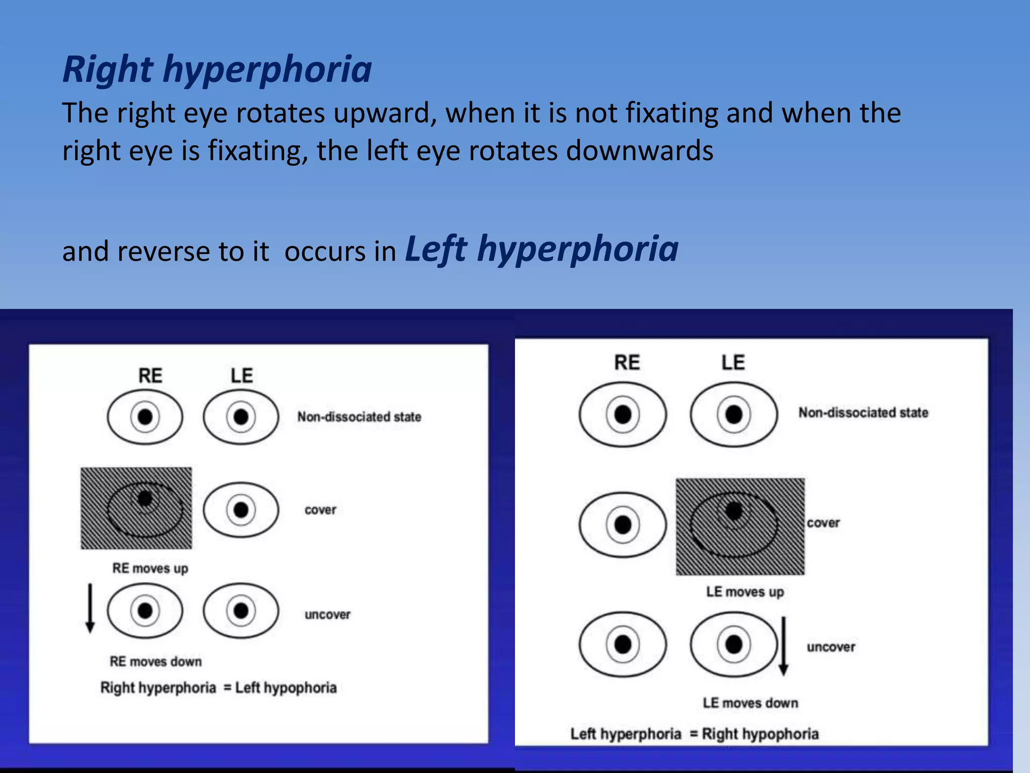 Heterophoria Or Latent Squint | PPTX