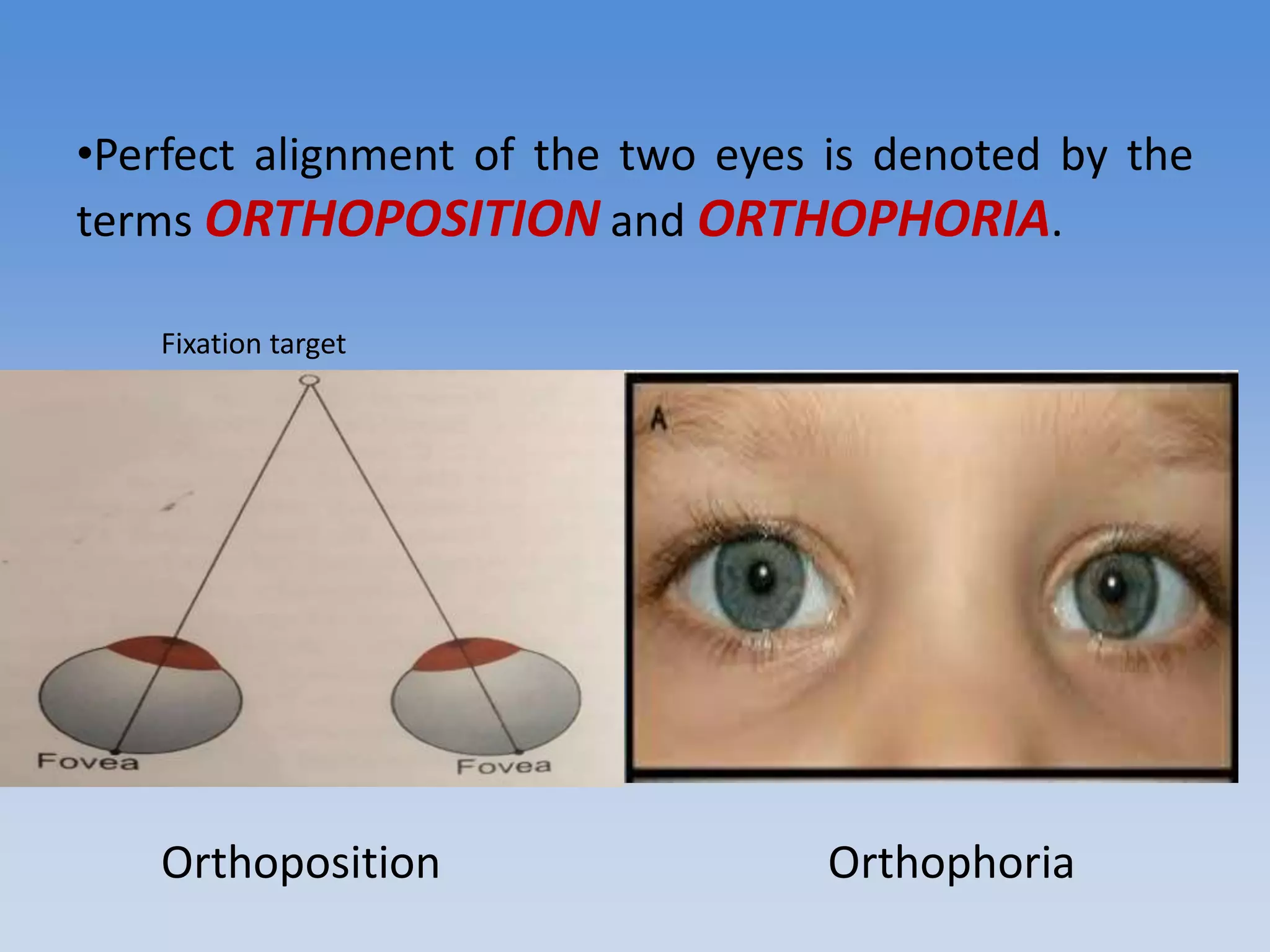 Heterophoria Or Latent Squint | PPTX