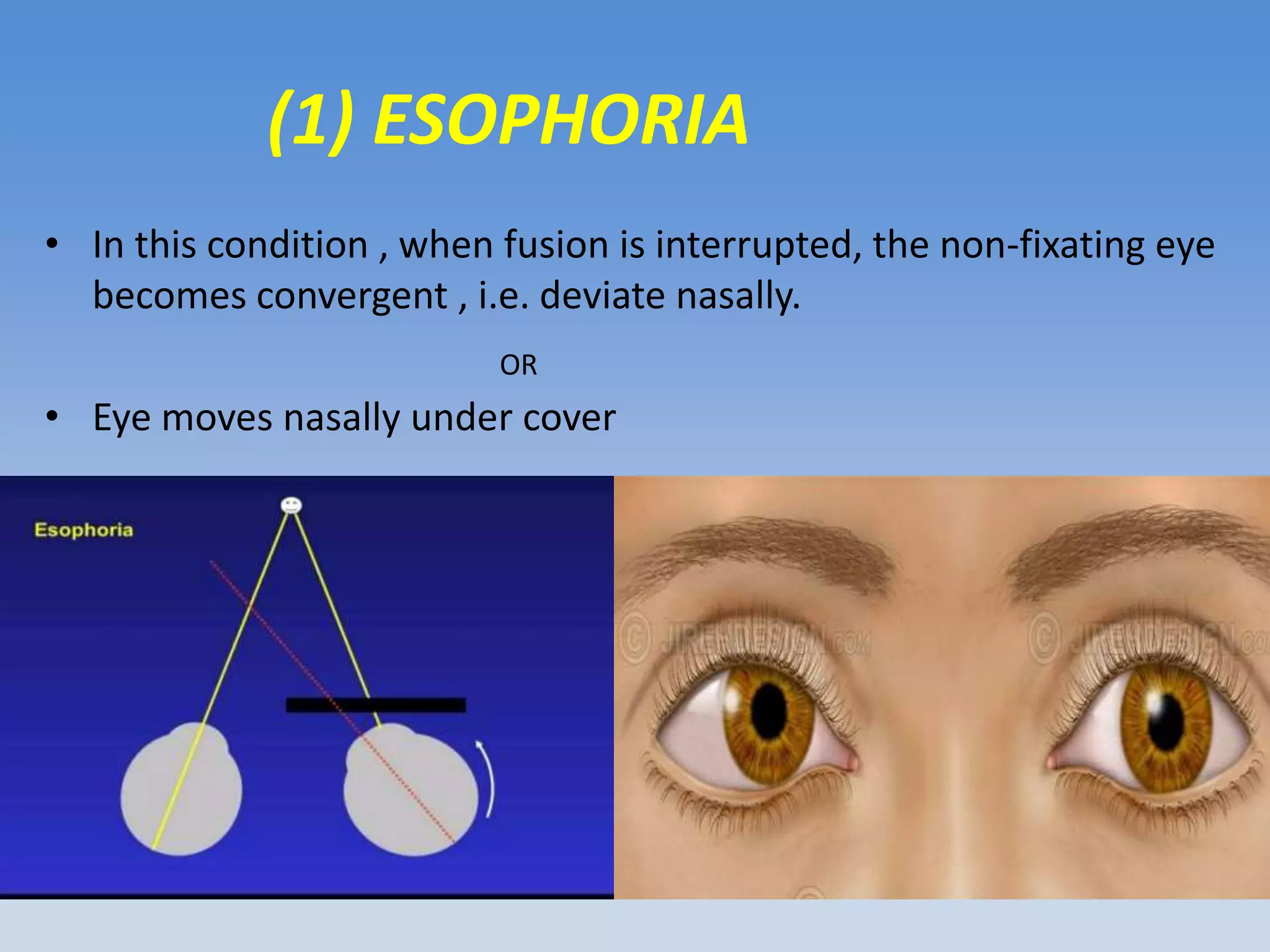 Heterophoria Or Latent Squint | PPTX