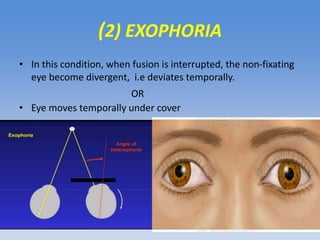 Heterophoria Or Latent Squint | PPTX
