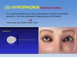 Heterophoria Or Latent Squint | PPTX