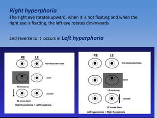 Heterophoria Or Latent Squint | PPTX