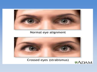 Heterophoria Or Latent Squint | PPTX
