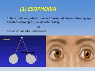 Heterophoria Or Latent Squint | PPTX