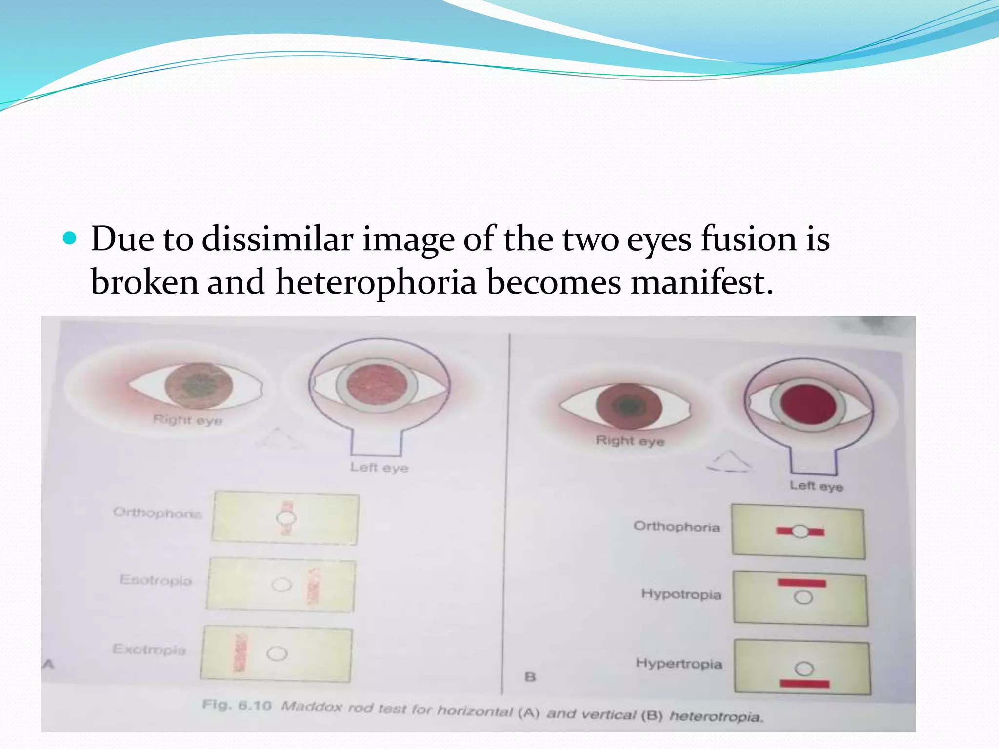 Heterophoria investigation and management | PPTX