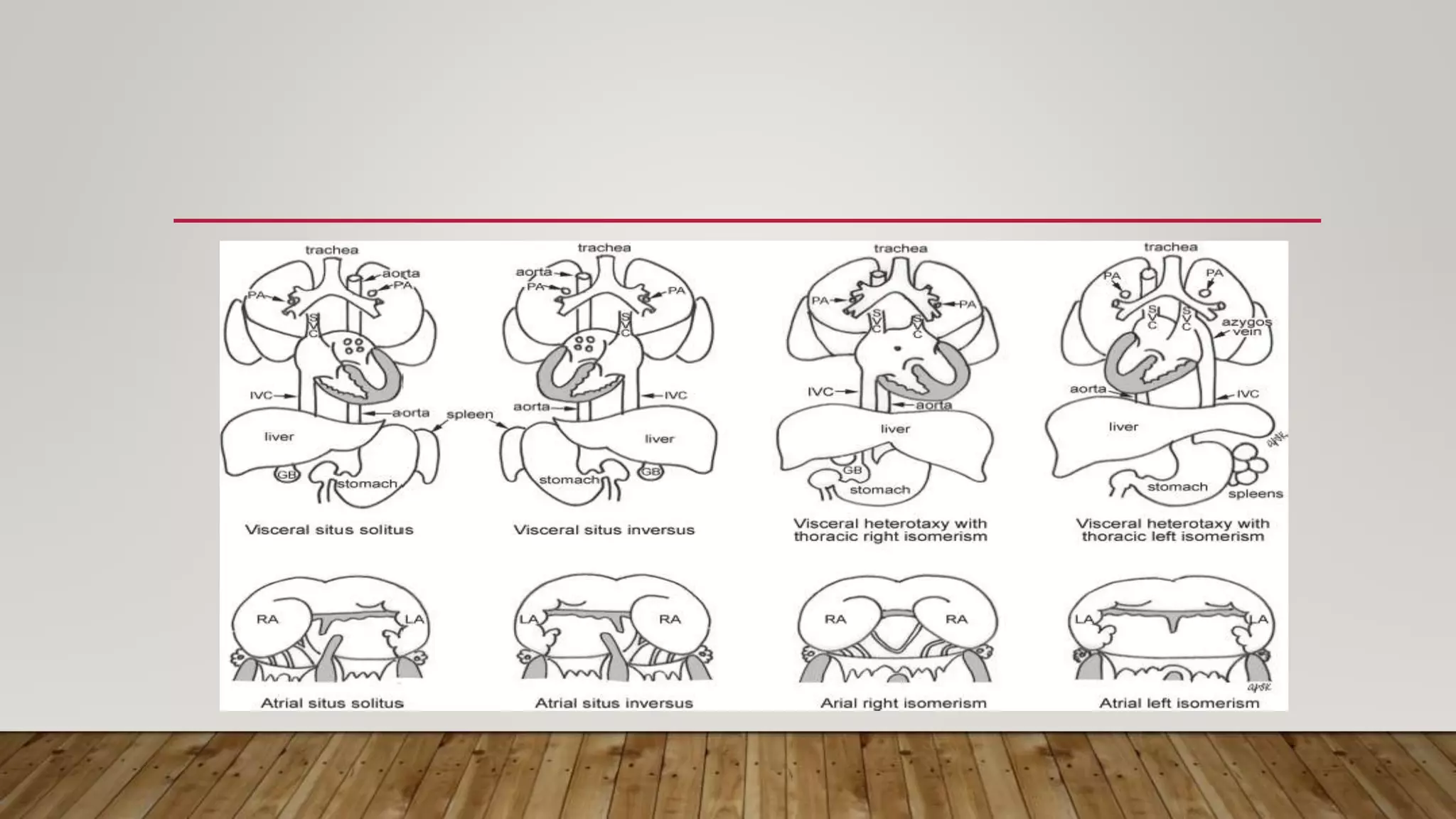 Heterotaxy syndrome.pptx | Heart and Cardiovascular Diseases | Diseases ...