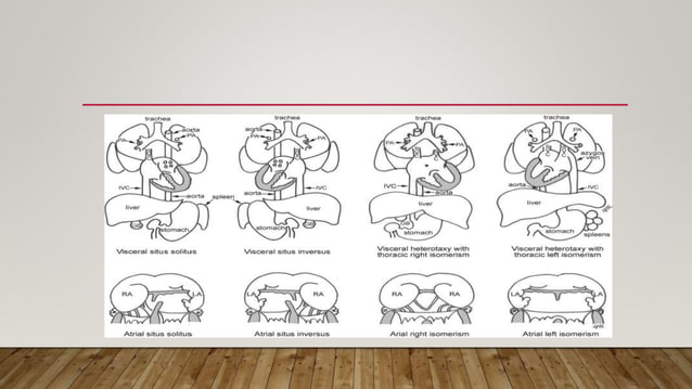 Heterotaxy syndrome.pptx | Heart and Cardiovascular Diseases | Diseases ...